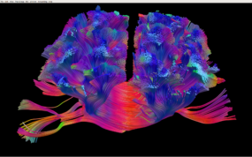 Corpus Callosum | The Neuro Bureau