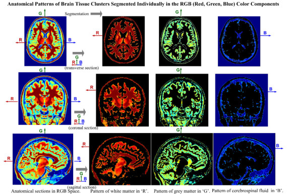 abstract_Anatomical Patterns of Brain Tissue Clusters Segmented ...