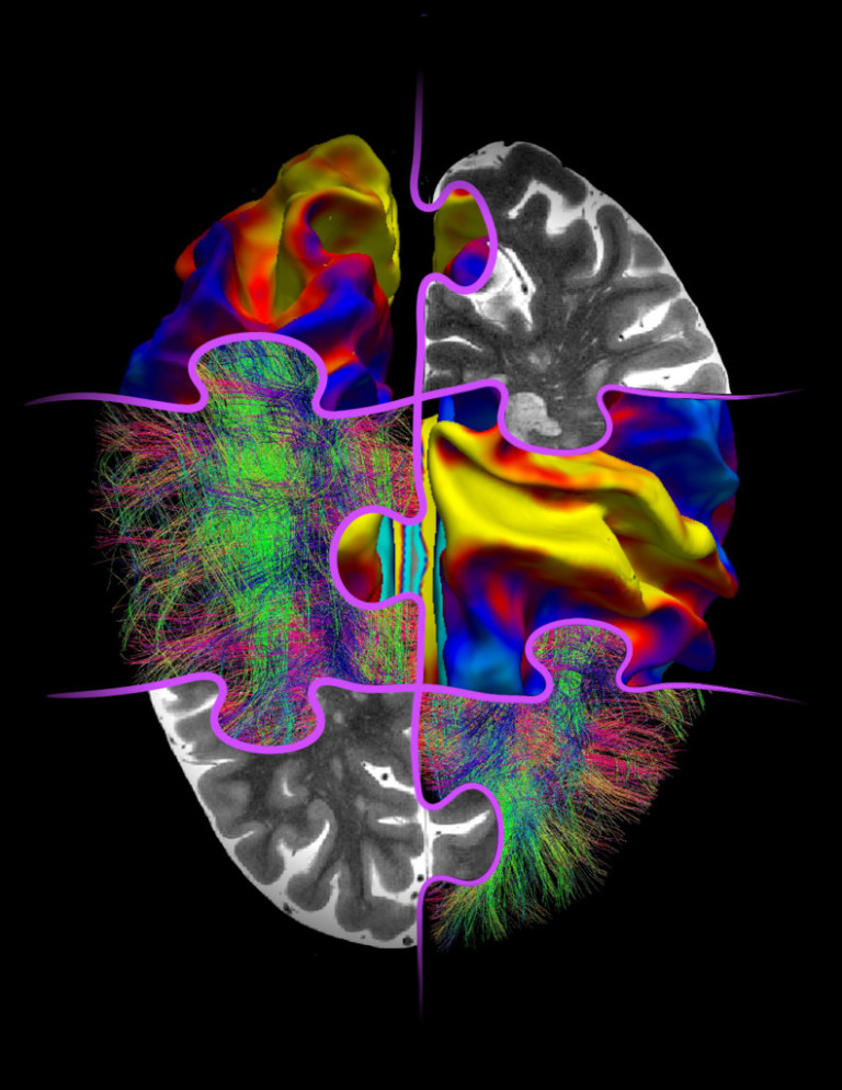 Bringing puzzle pieces from multimodal MRI together to see the big picture of Multiple Sclerosis ...